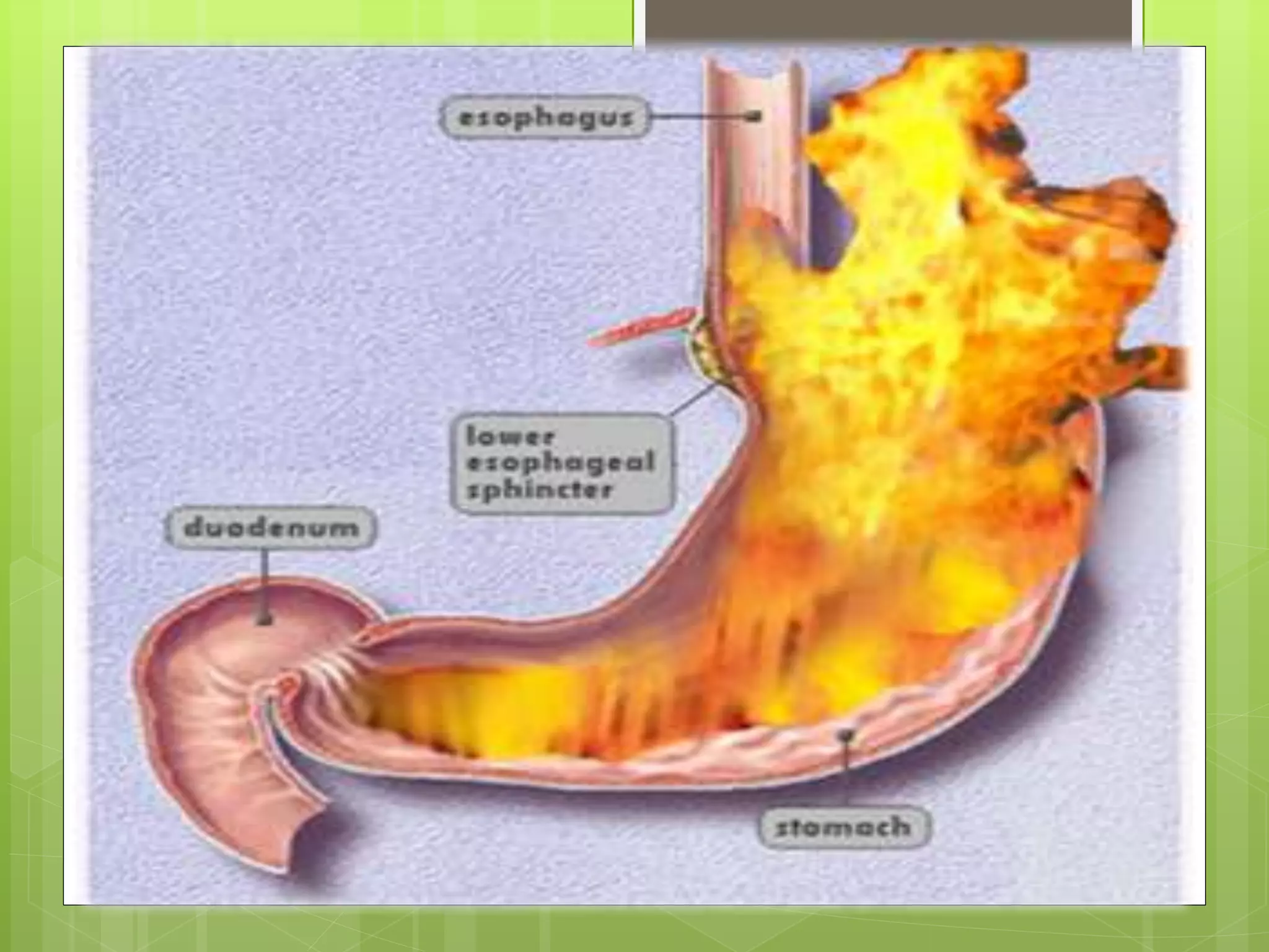 Gerd presentation ( Case study ) | PPSX