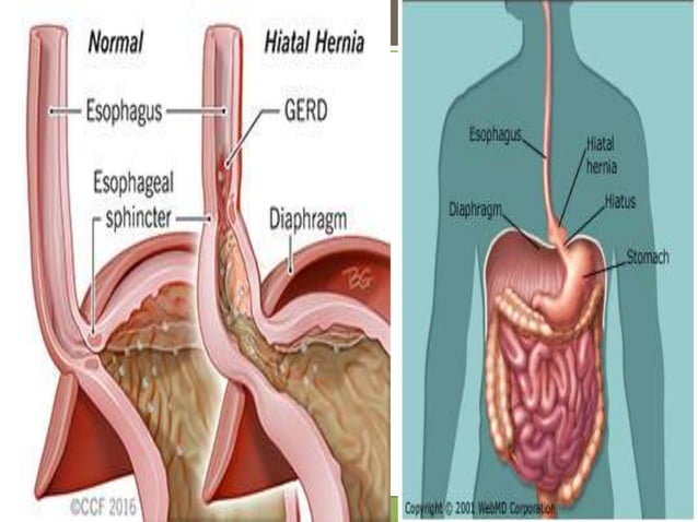 Gerd presentation ( Case study ) | PPSX