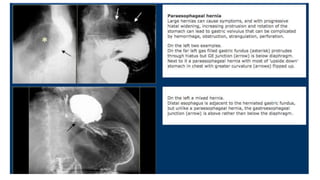 GERD (gastro esophageal reflux disease) and Achalasia cardia | PPTX
