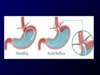 GERD Presentation.pptx