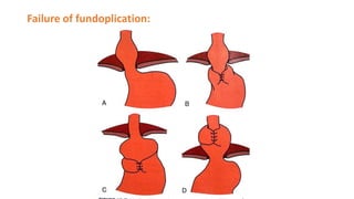 Gerd surgical management | PPTX