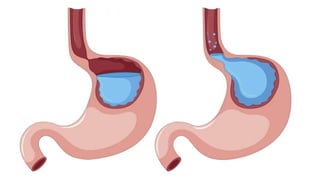 GERD: Symptoms and Causes | PPT