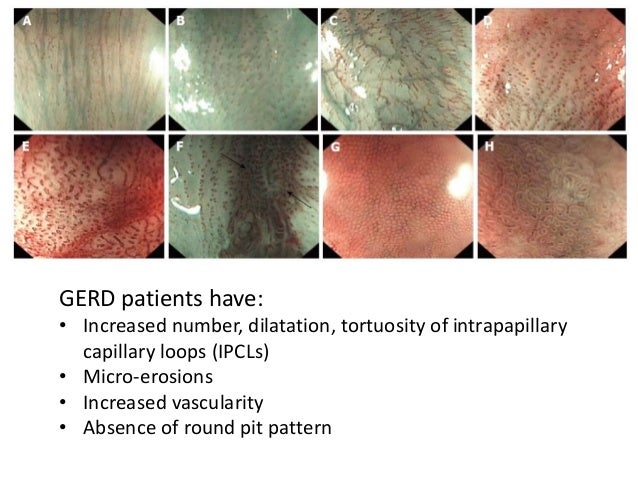 GERD: Telling Fact from Fiction