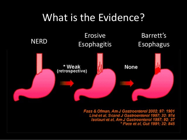 GERD: Telling Fact from Fiction