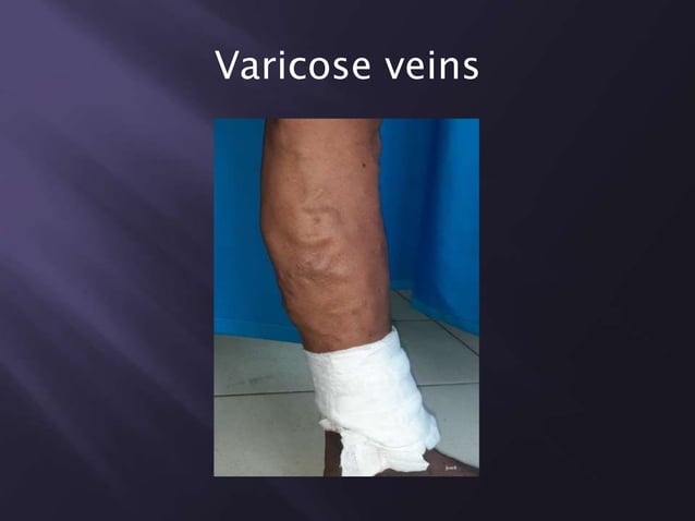 Managing Venous Ulcers Pre-congress Workshop Wound Care in the Elderly ...