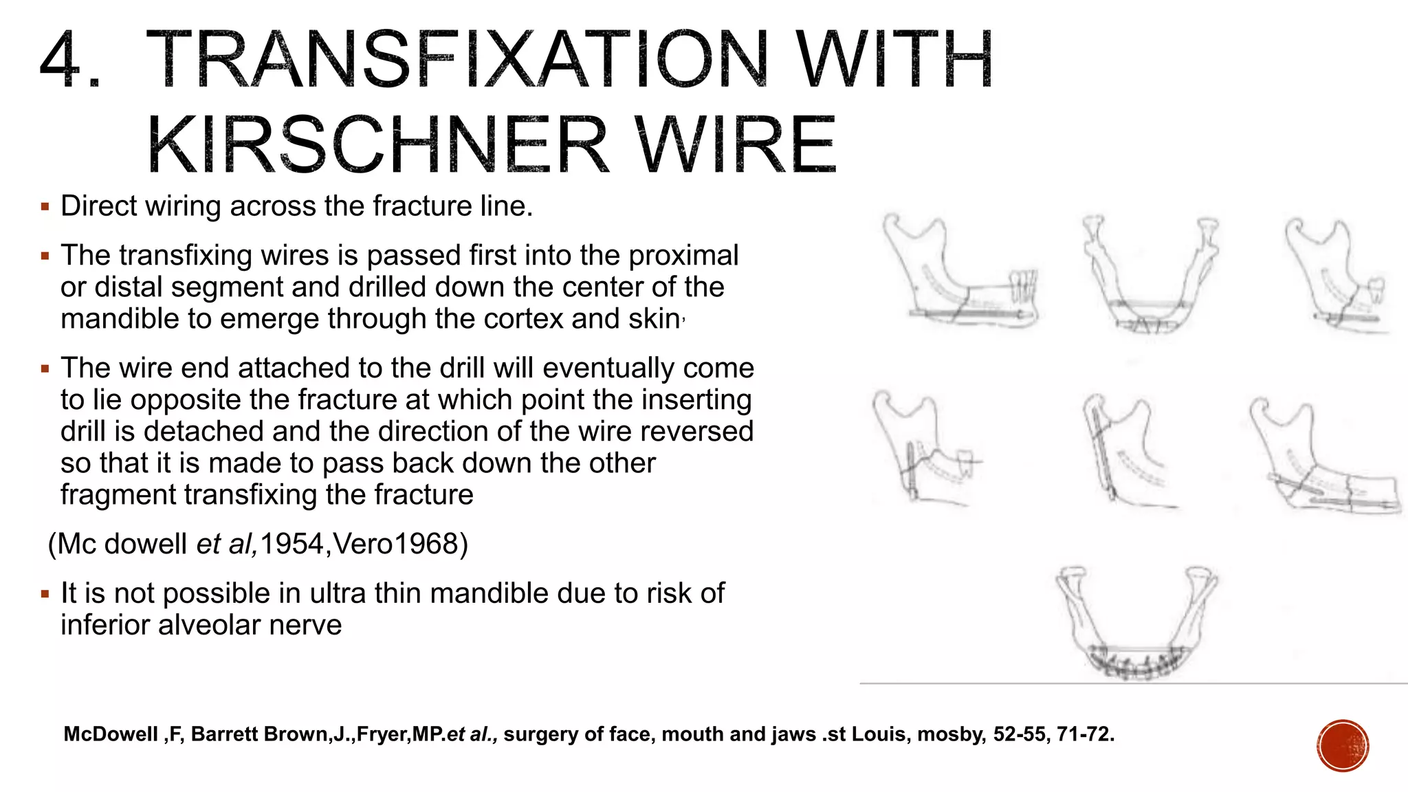 Geriatric fracture | PPTX