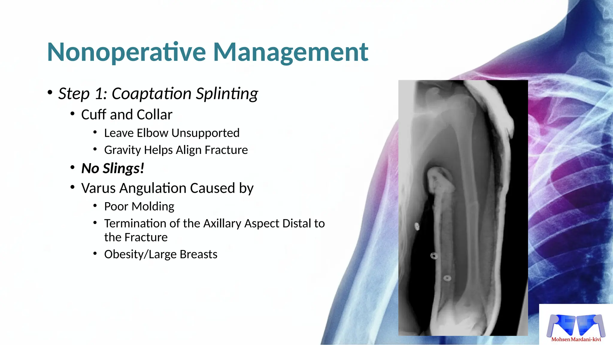 Geriatric Fractures Around the Shoulder & Elbow - Copy.pptx