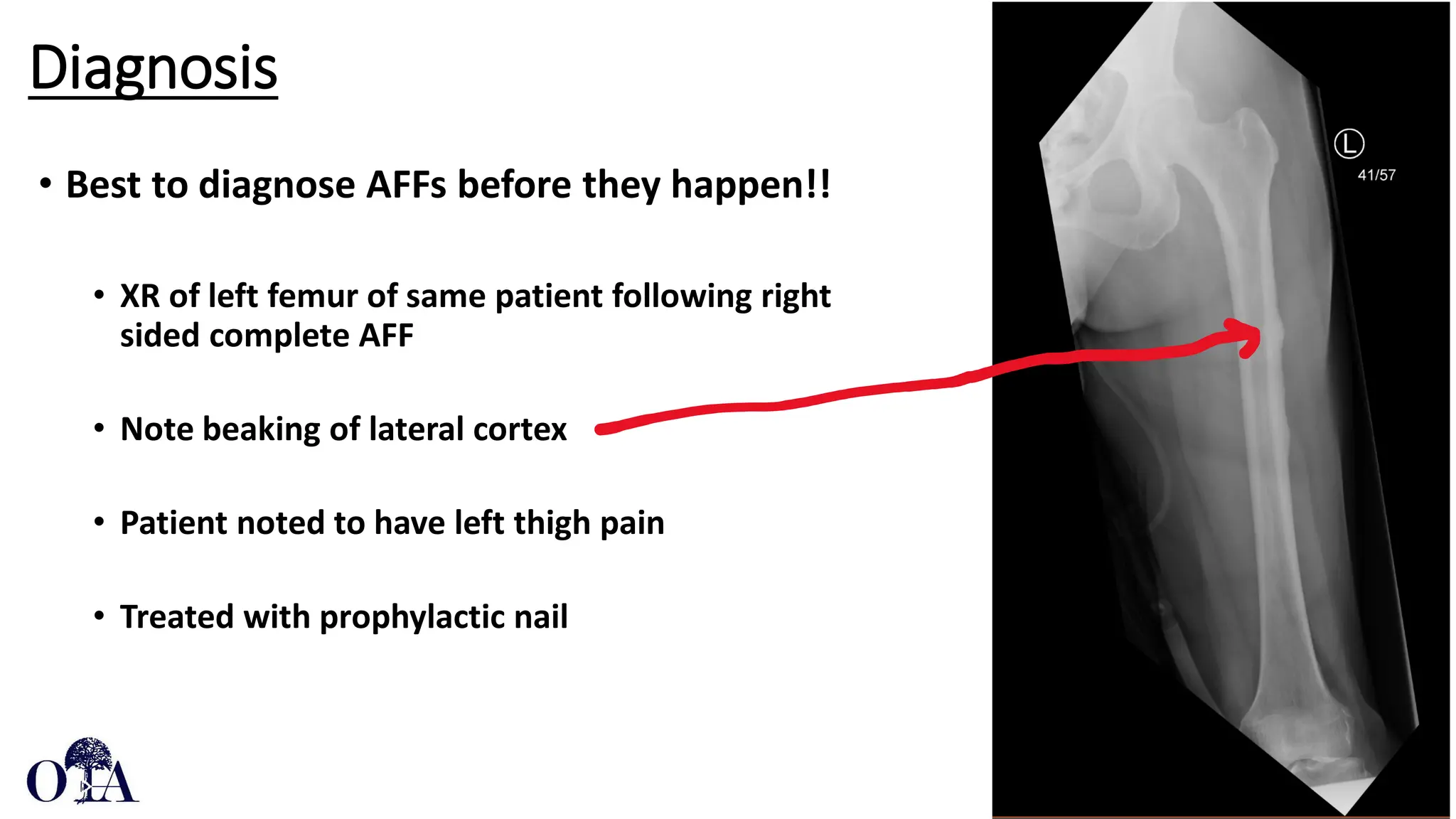 Geriatric Fx 2 Atypical Femur Fractures.pdf