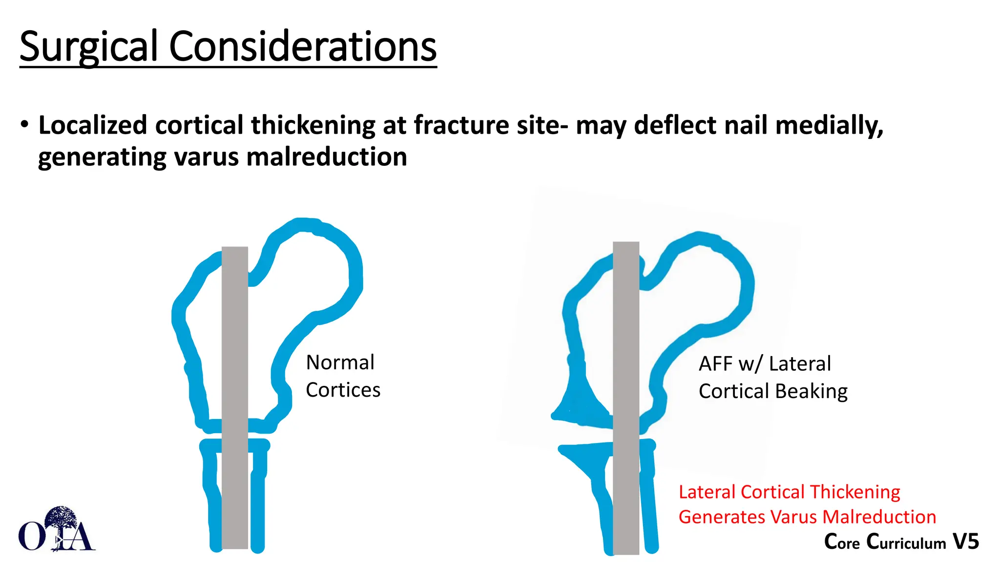 Geriatric Fx 2 Atypical Femur Fractures.pdf