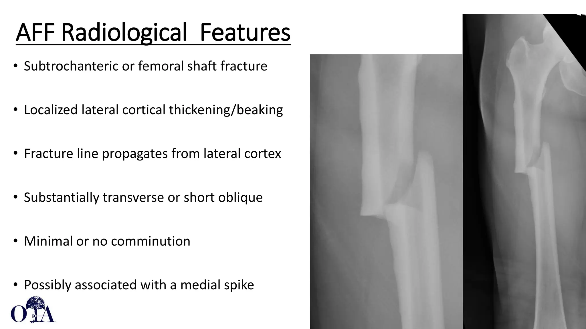 Geriatric Fx 2 Atypical Femur Fractures.pdf