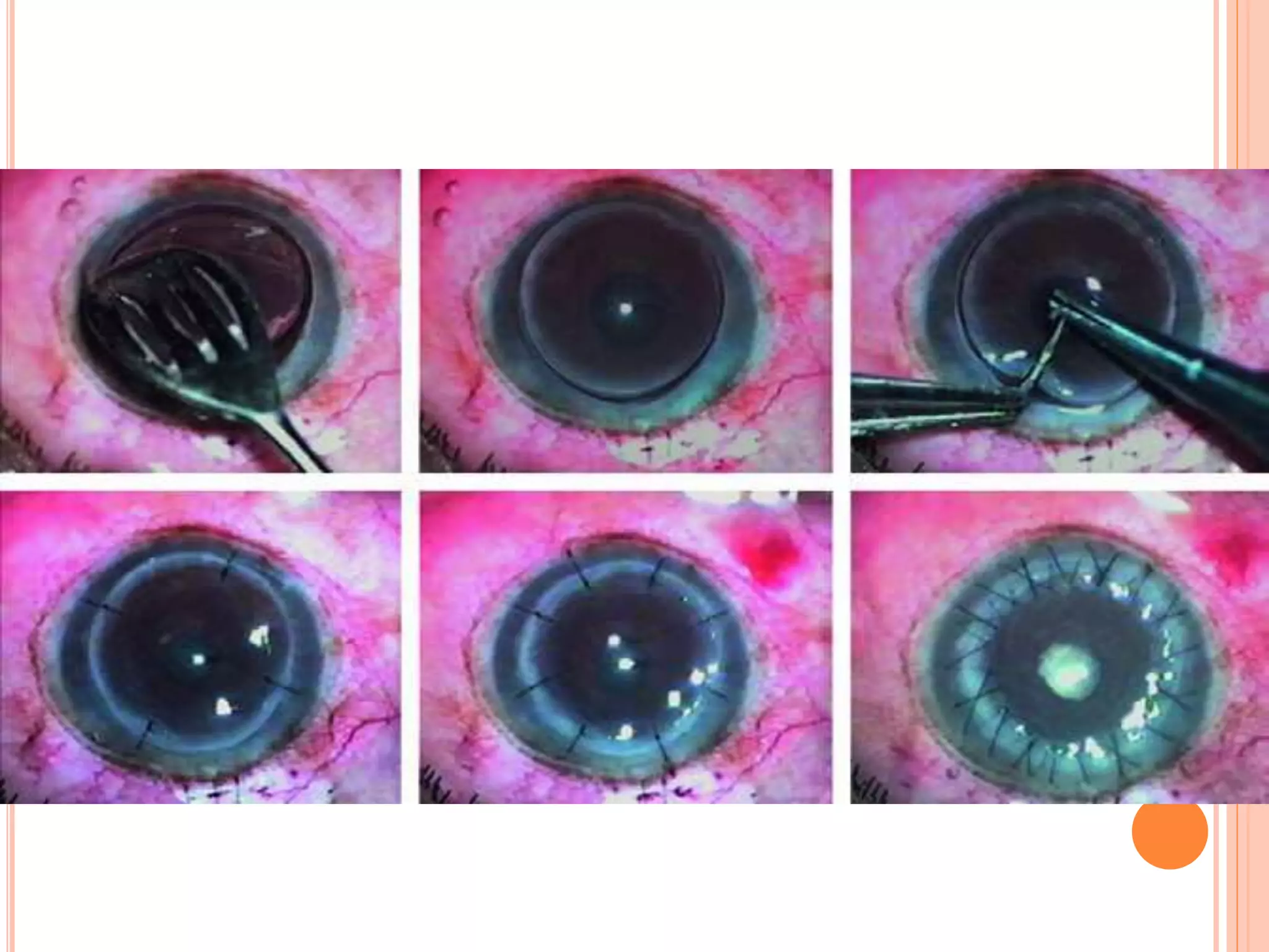 Geriatric ophthalmology | PPTX