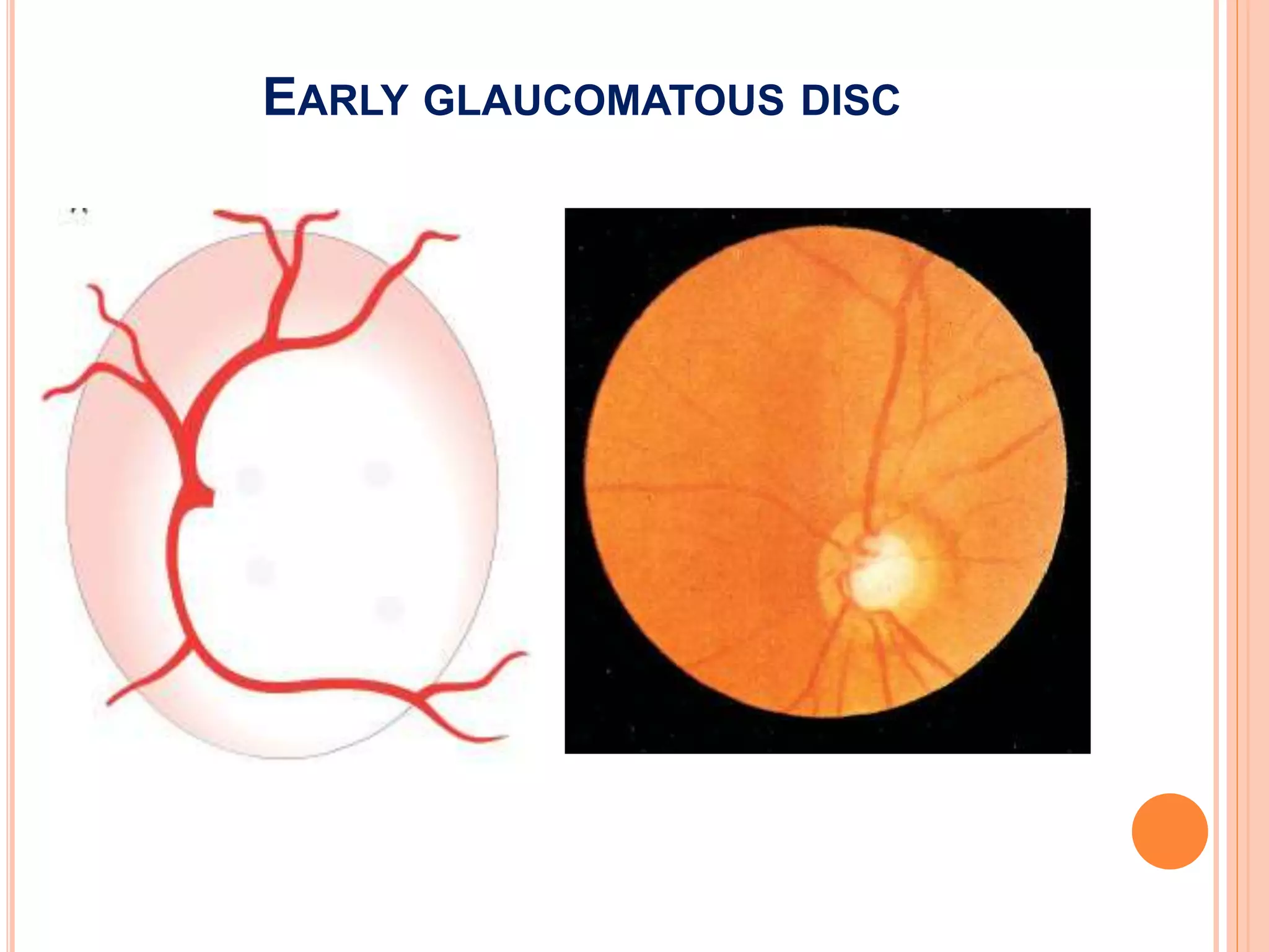 Geriatric ophthalmology | PPTX