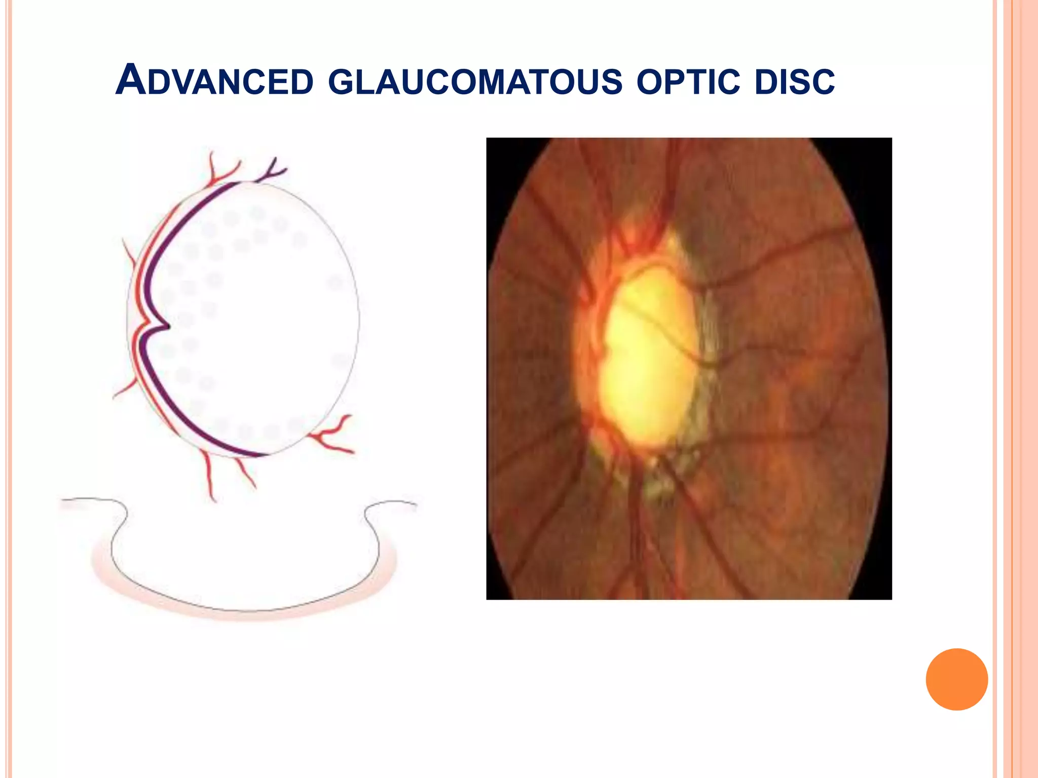 Geriatric ophthalmology | PPTX