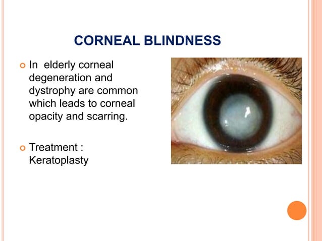 Geriatric ophthalmology | PPTX | Eye and Vision Conditions | Diseases ...
