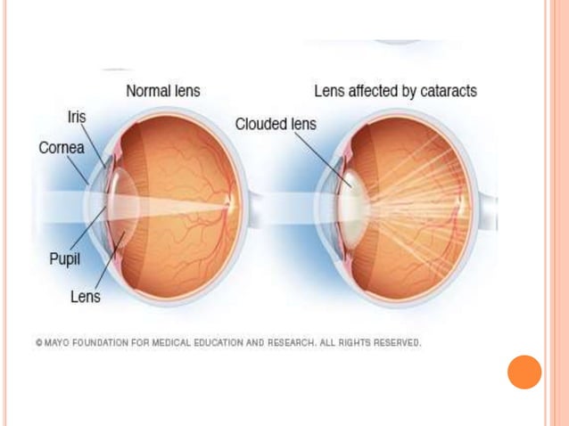 Geriatric ophthalmology | PPTX | Eye and Vision Conditions | Diseases ...