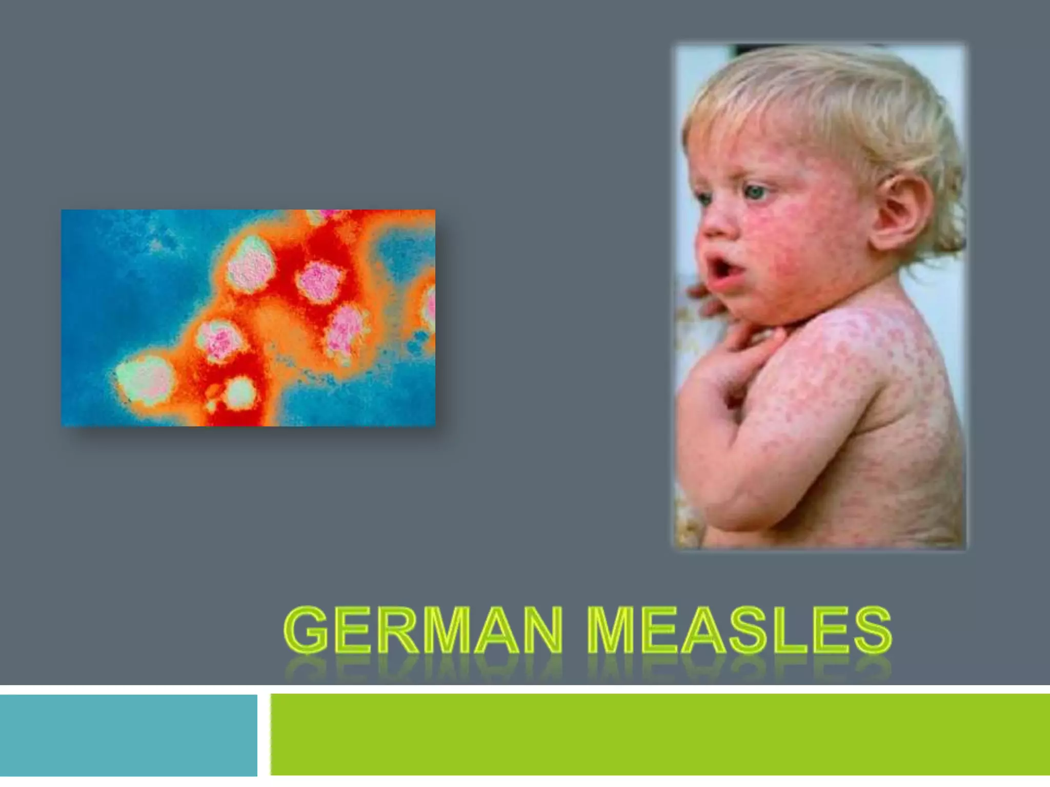 German measles | PPTX