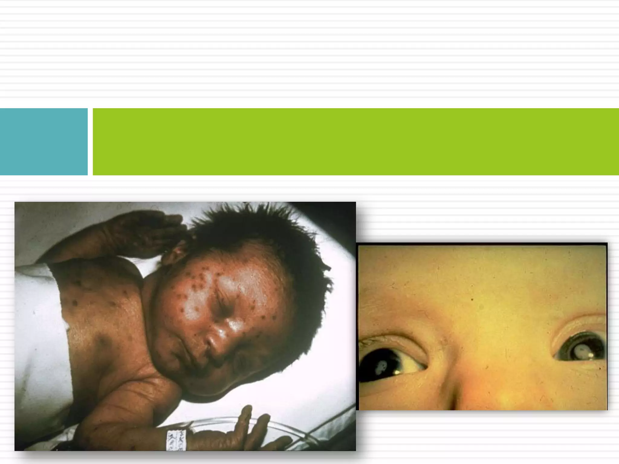 German measles | PPTX