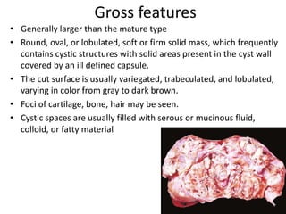 Germ cell tumors of ovary | PPTX
