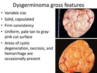 Ovary Dysgerminoma Gross