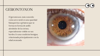 gerontoxon patologia ocular anterior geriatria | PDF