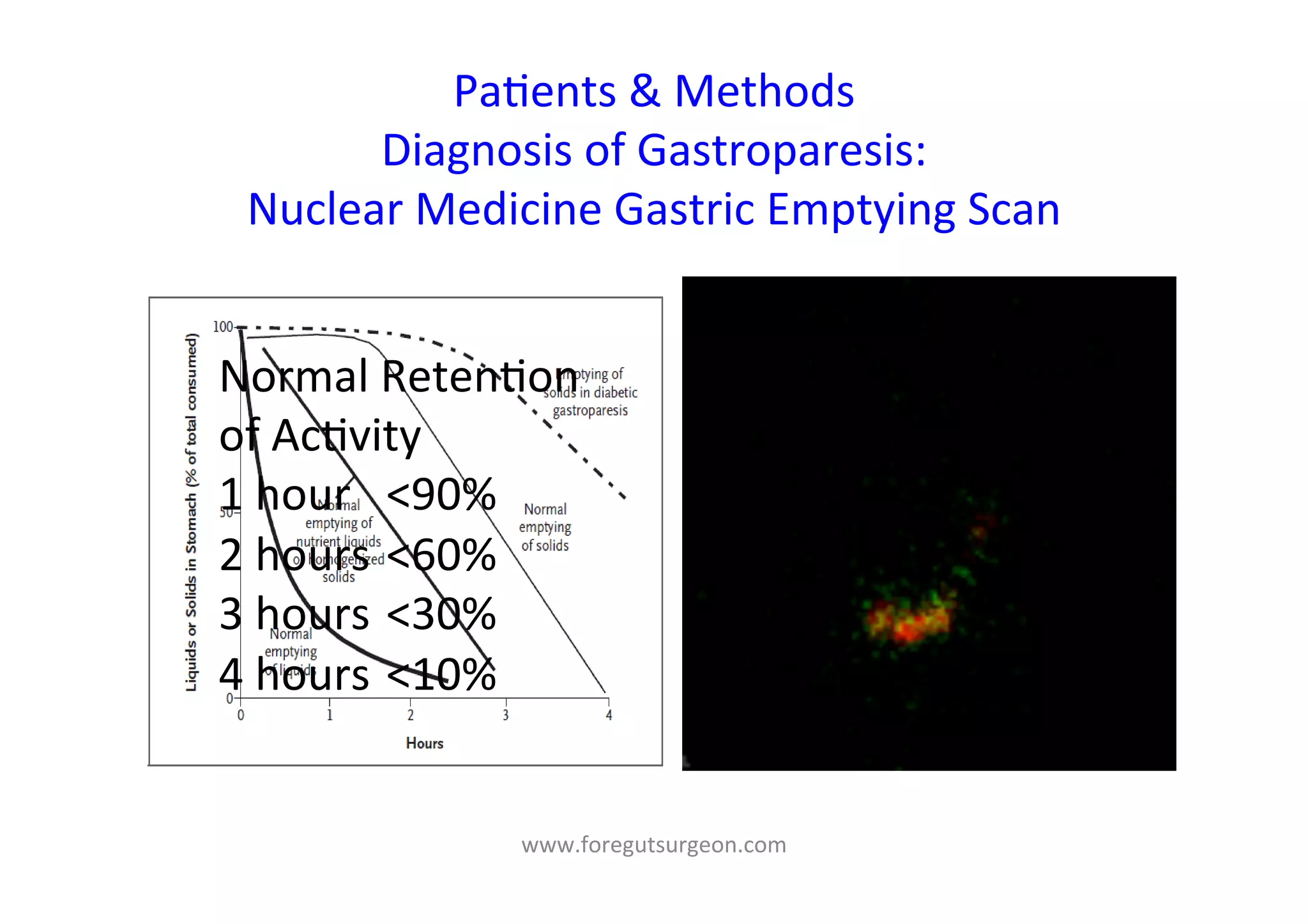 Gastric Electrical Stimulation for Gastroparesis | PDF