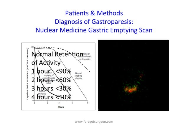Gastric Electrical Stimulation for Gastroparesis | PDF | Digestive ...
