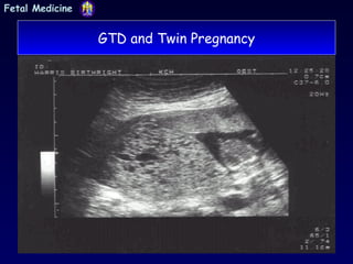 Gestational Trophoblastic Disease - www.jinekolojivegebelik.com