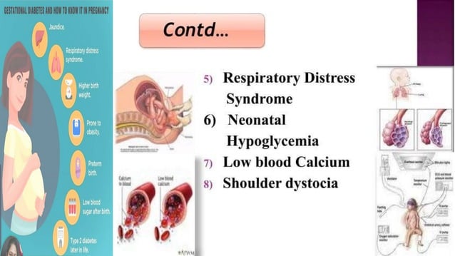 GESTATIONAL DIABETES MELLITUS.pptx GDM | PPT