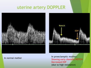 Hypertensive disorders in Pregnancy | PPTX