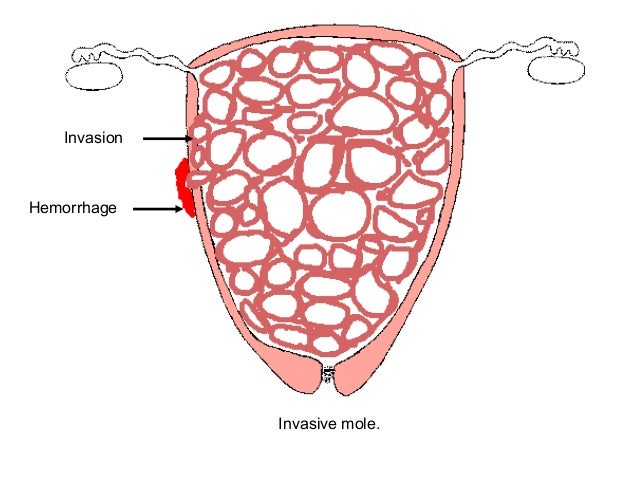 Gestational trophoblastic disease