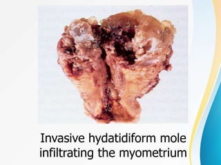 Gestational Trophoblastic Disease.ppt
