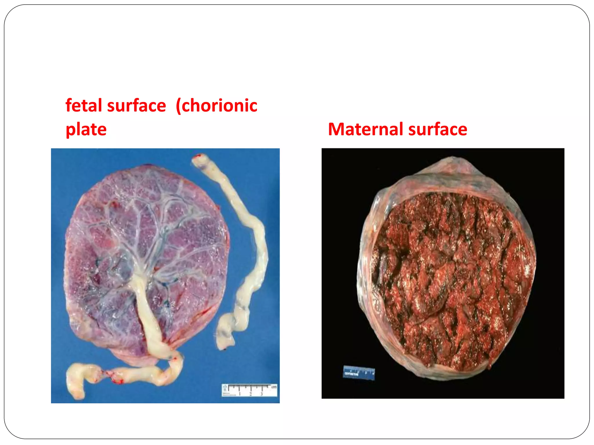 Gestational trophoblastic disease | PPTX
