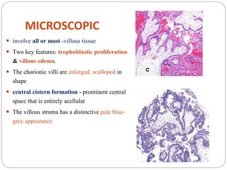 Gestational trophoblastic disease | PPTX