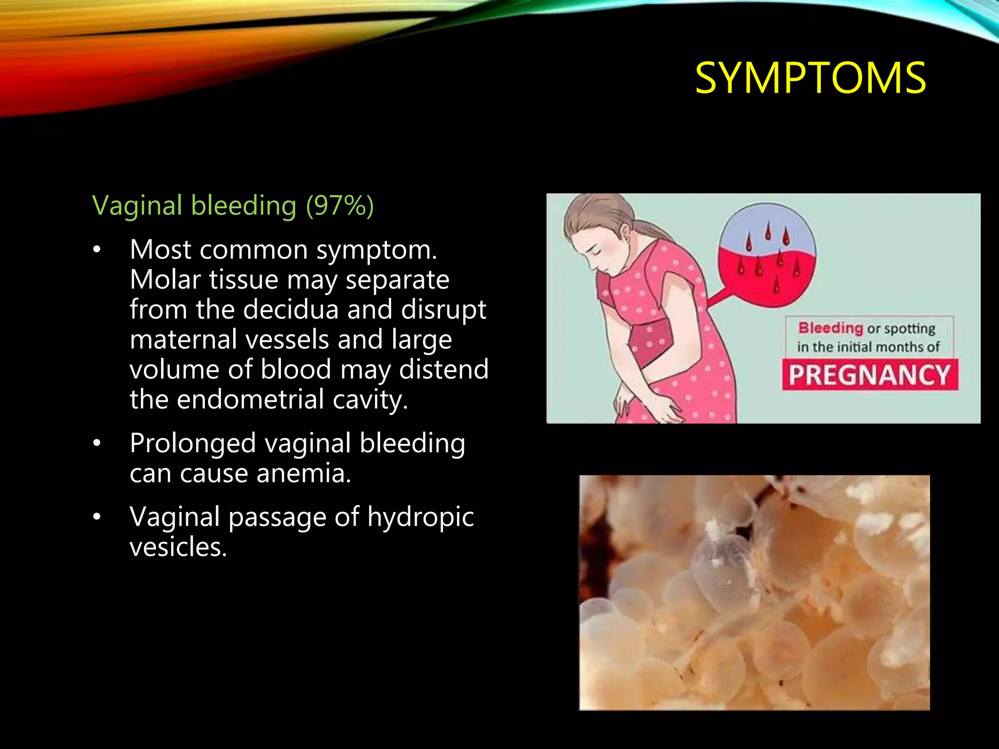 Gestational trophoblastic disease | PPTX
