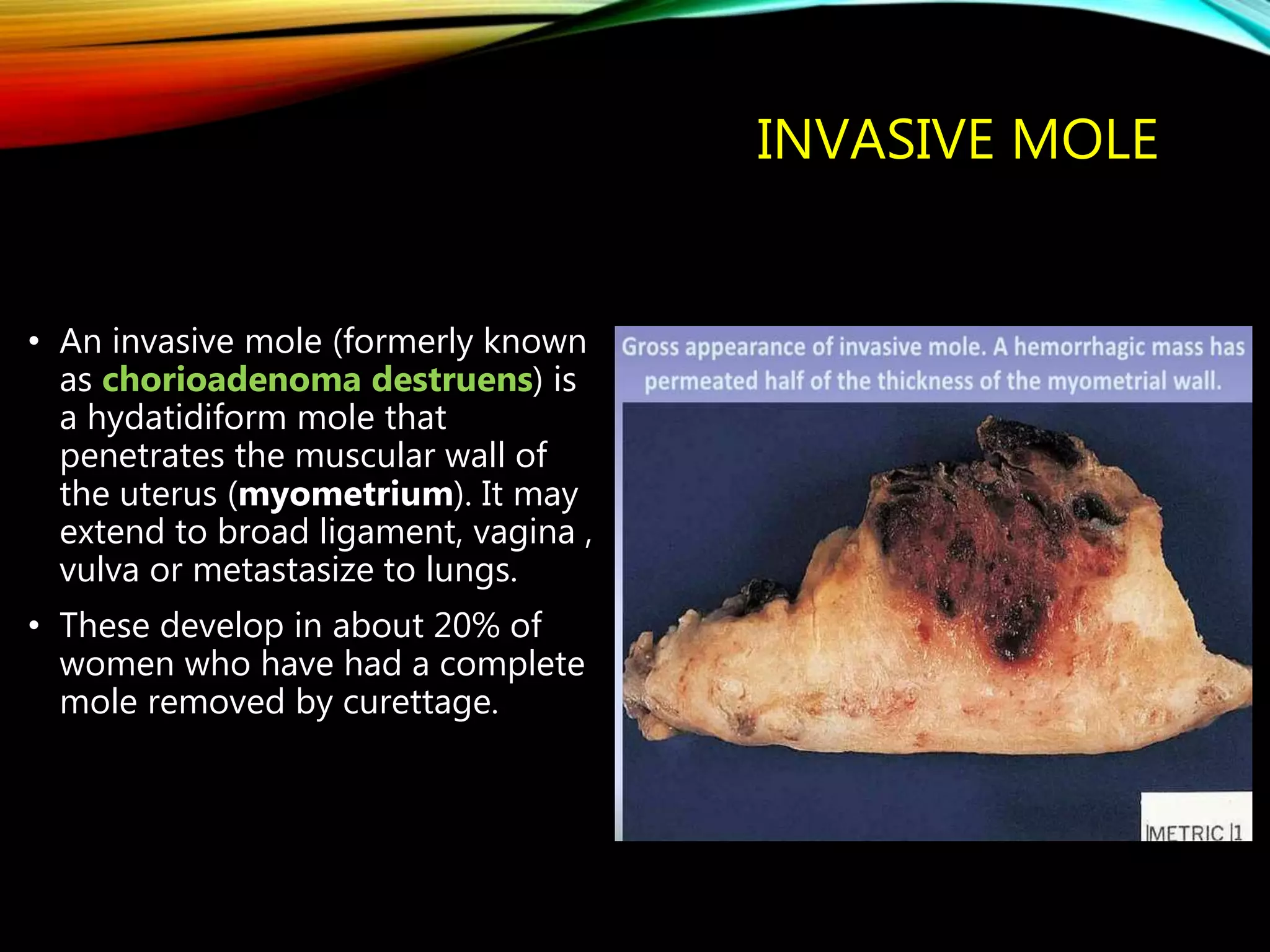 Gestational trophoblastic disease | PPTX