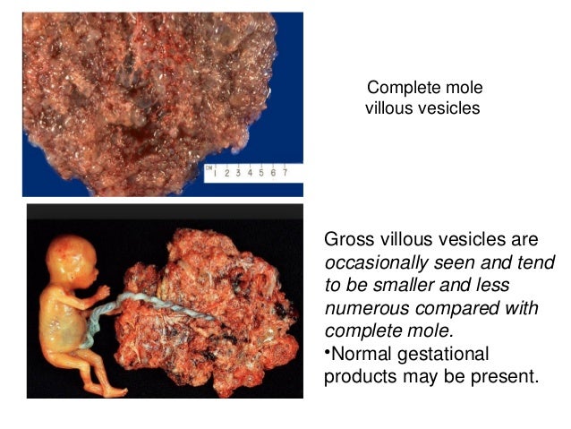 Gestational trophoblastic disease by sittichoke
