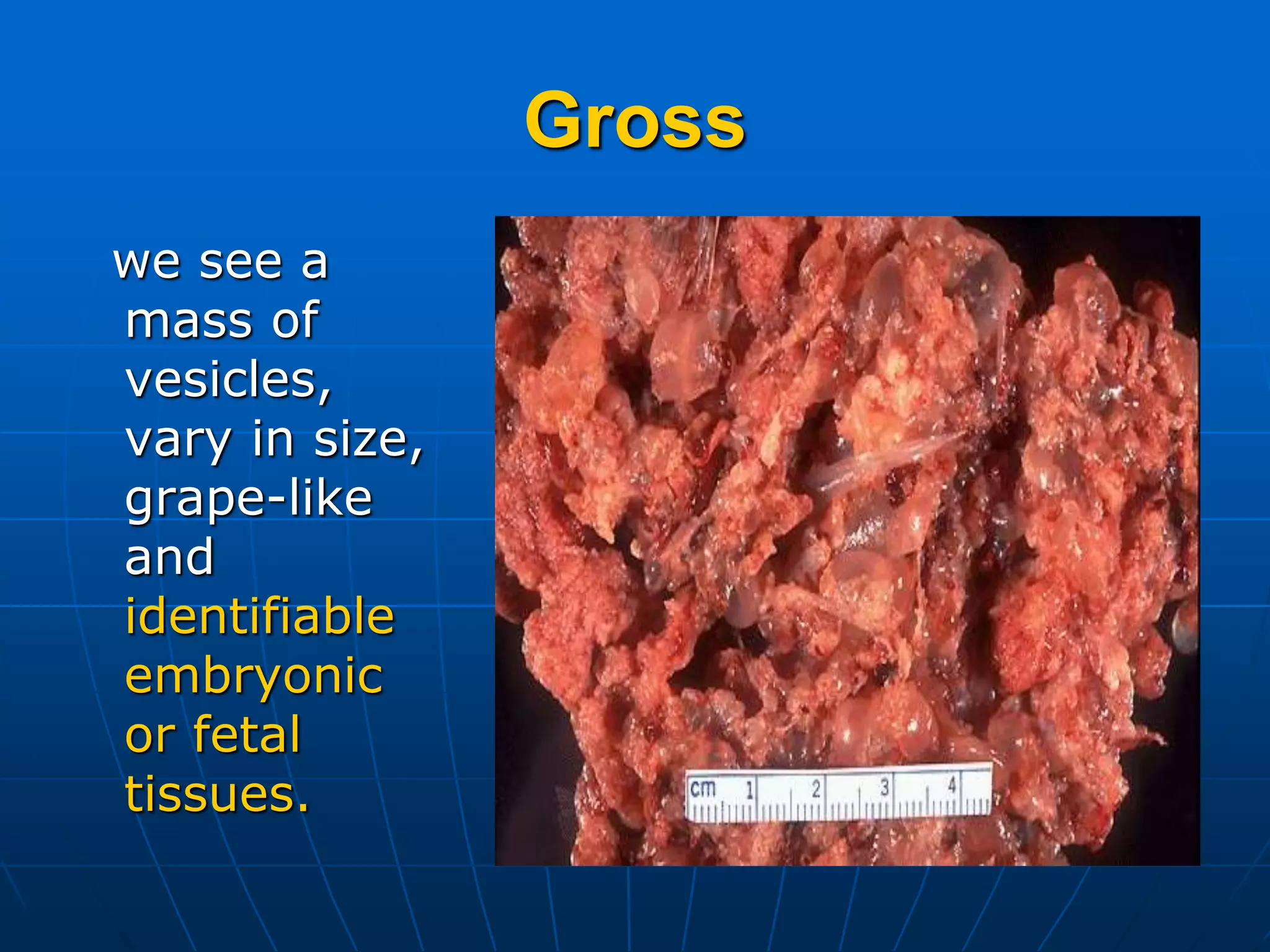 Gestational trophoblastic disease (gtd.version gao) | PPTX