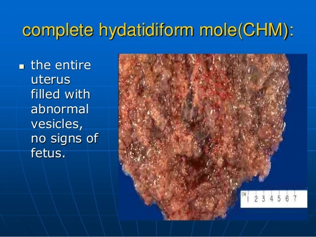Gestational trophoblastic disease (gtd.version gao)