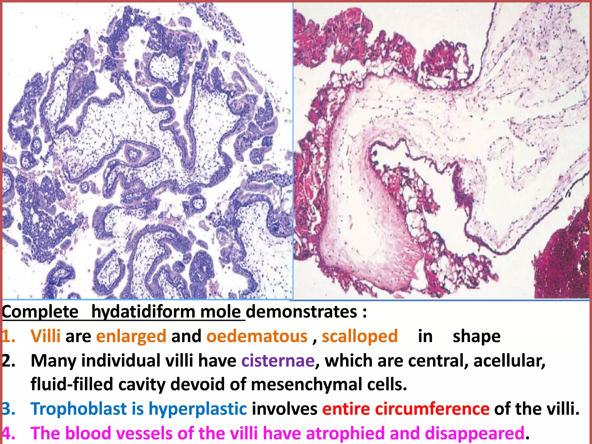Gestational trophoblastic disease (GTD).pptx