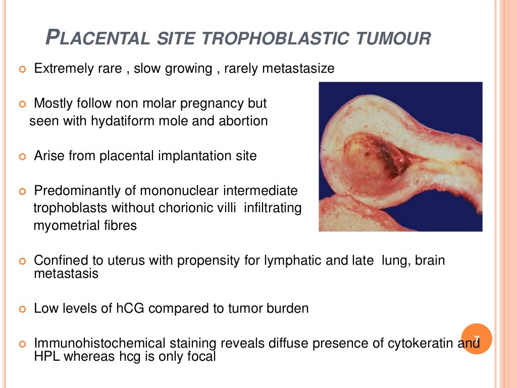 Gestational trophoblastic disease part 2-1 - copy
