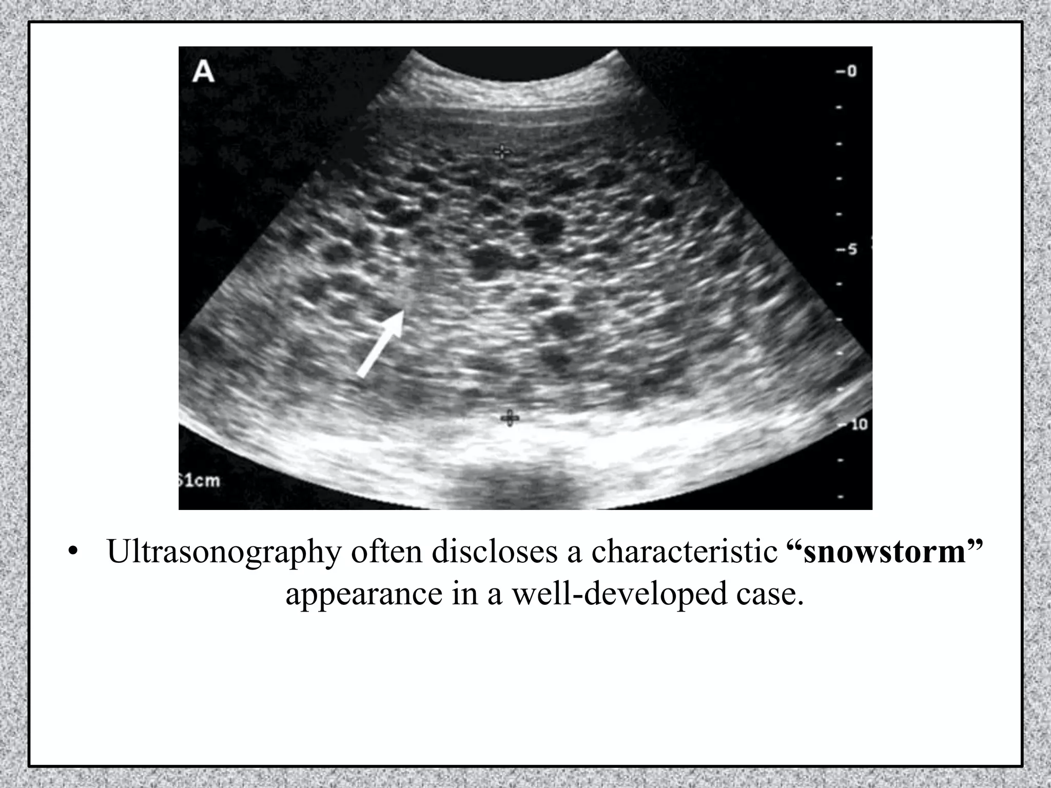 GESTATIONAL TROPHOBLASTIC DISEASES.pptx