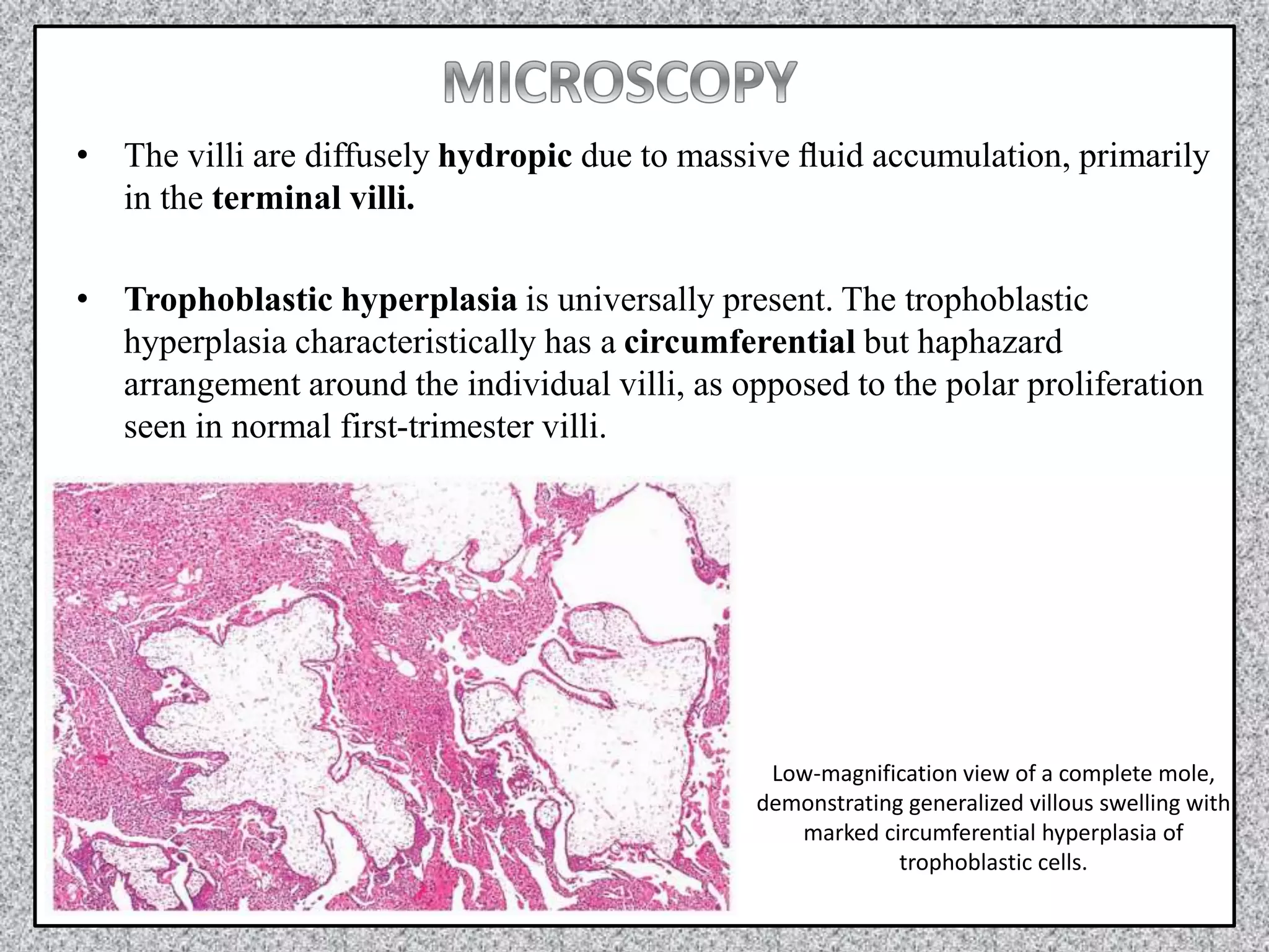GESTATIONAL TROPHOBLASTIC DISEASES.pptx