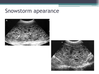 Gestational trophoblastic diseases (GTD) | PPTX
