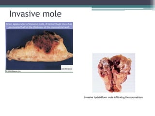 Gestational trophoblastic diseases (GTD) | PPTX