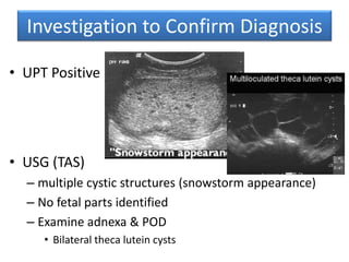 Gestational trophoblastic neoplasia | PPT