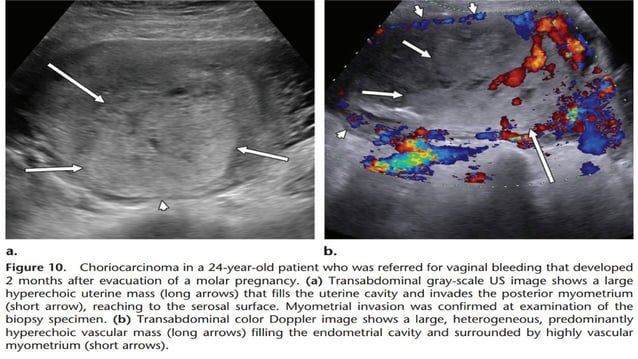 Gestational trophoblastic neoplasia.pptx