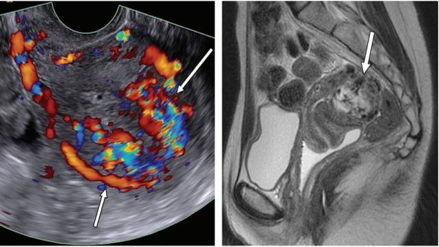 Gestational trophoblastic neoplasia.pptx