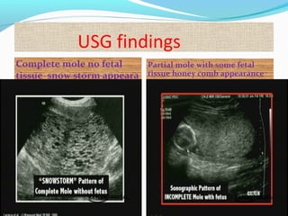 Gestational trophoblastic neoplasia (2).ppt44444 | PPT