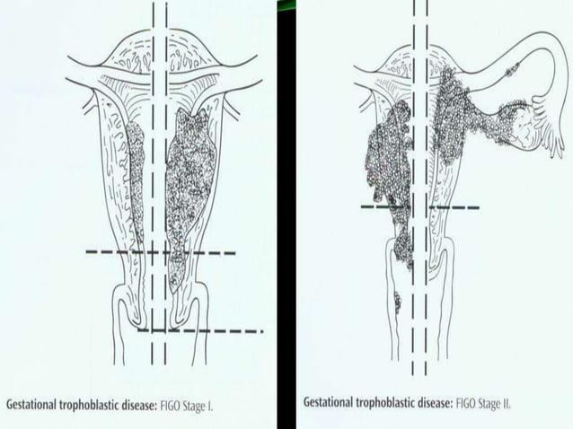 Gestational trophoblastic neoplasia | PPTX | Infertility | Reproductive ...