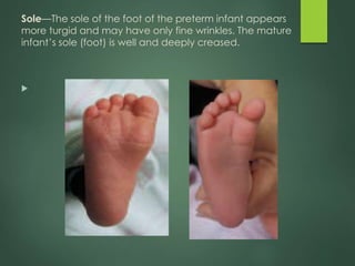 Gestational age assessment of infant | PPTX